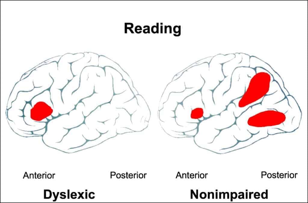Decoding Dyslexia: Common Misconceptions - Makchic