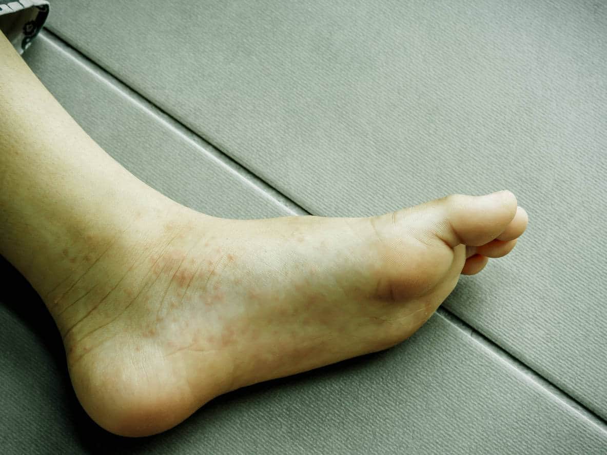 Here’s What You Should Know About HFMD - Makchic